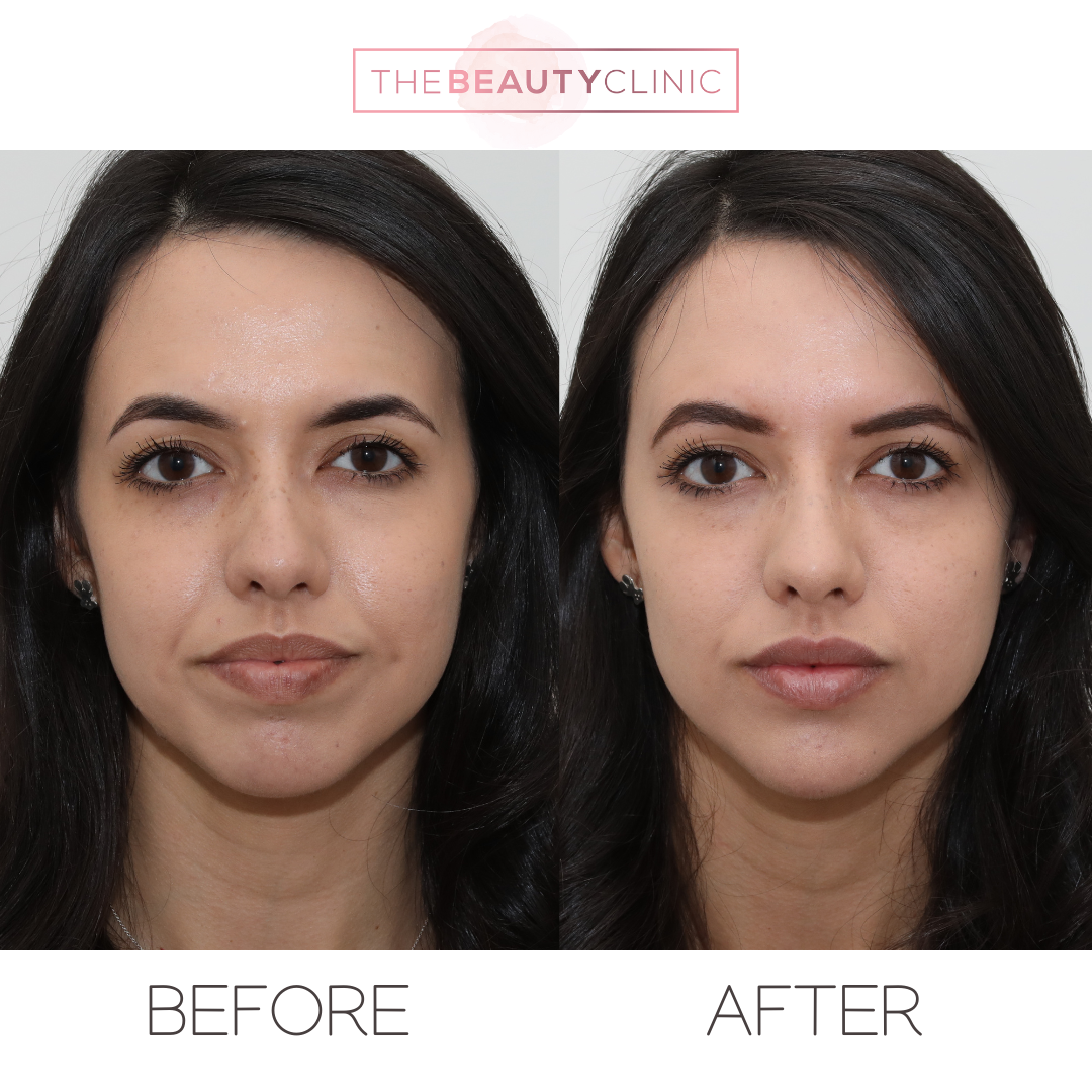 Natural Filler Results In Aventura Fort Lauderdale Natural Filler Results In Aventura Fort Lauderdale