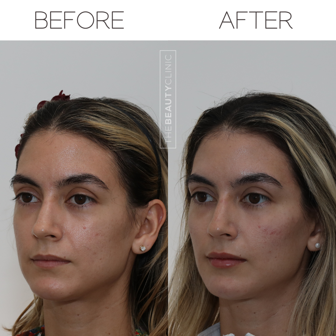 Natural Filler Results In Aventura Fort Lauderdale Natural Filler Results In Aventura Fort Lauderdale