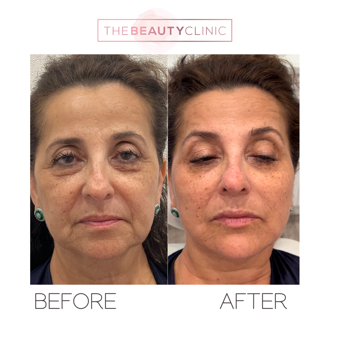 Natural Filler Results In Aventura Fort Lauderdale Natural Filler Results In Aventura Fort Lauderdale